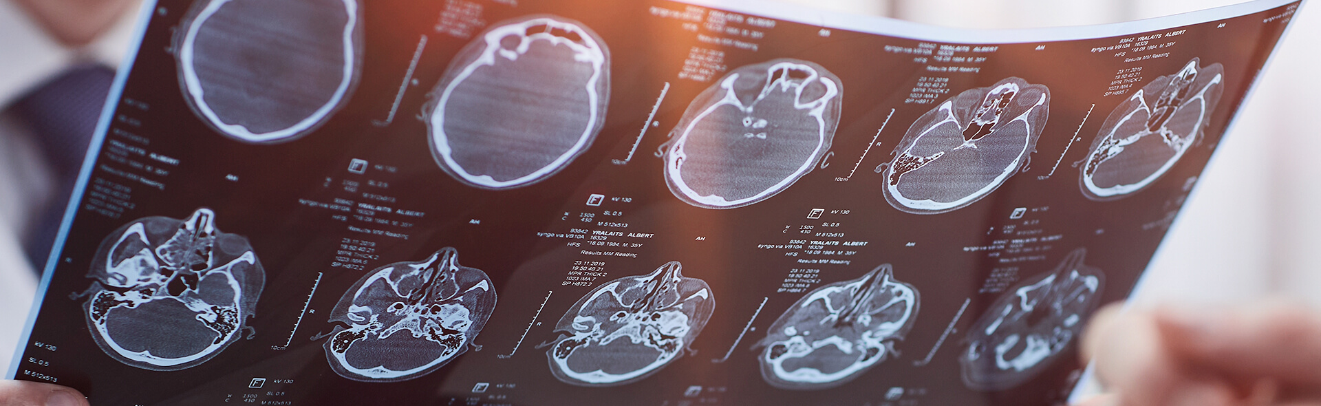 Brain Injury Lawyer | Traumatic Brain Injuries & More